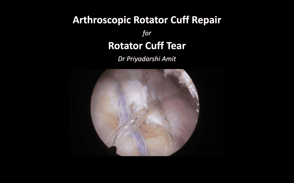 Arthroscopic Rotator Cuff Repair For Rotator Cuff Tear - Explained - Dr ...