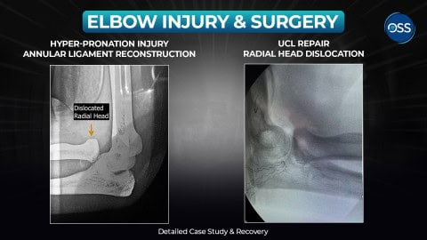 Anatomic Annular Ligament Reconstruction For Radial Head Dislocation ...